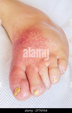 erysipelas of the legs, red rash on the legs.selectivw focus Stock ...