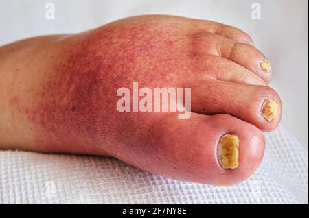erysipelas of the legs, red rash on the legs.selectivw focus Stock ...