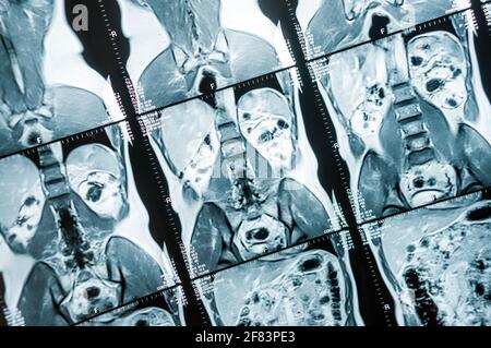 Cross section abdominal MRI (magnetic resonance imaging) scan of a 60 ...