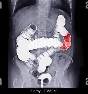 barium enema demonstrated cecum and colon for diagnosis Colorectal ...