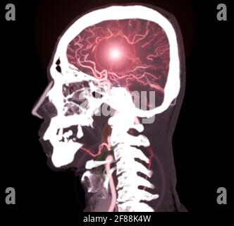 colorful of CT angiography of the brain or CTA brain Sagittal view ...