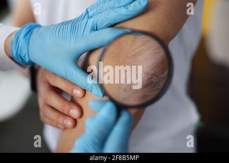Doctor examines patient scaly elbow through magnifying glass Stock ...