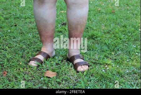 Chronic venous (vein) insufficiency in the leg of an adult woman ...