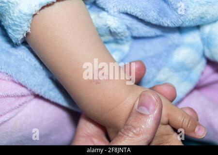Hemangioma red birthmark on the leg of newborn baby Stock Photo - Alamy