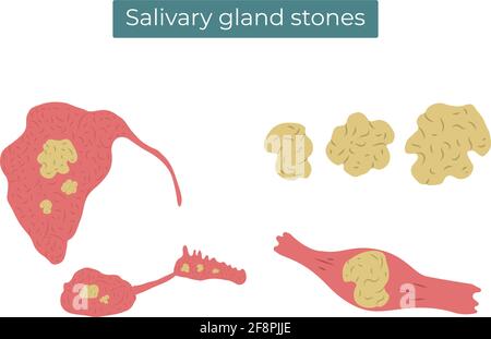 Vector illustration of stones in the salivary glands. Sialolithiasis ...
