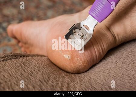 Dry mazole on a cracked heel male or corns. Close-up Stock Photo - Alamy