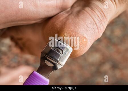 Dry mazole on a cracked heel male or corns. Close-up Stock Photo - Alamy