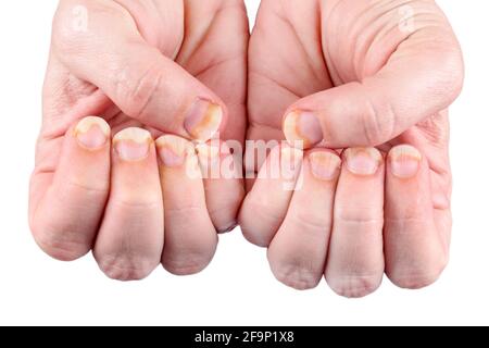 Hand with longitudinal ridging nails isolated on white background Stock ...