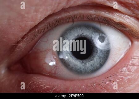 Closeup of diseased eye with red dilated vessels Stock Photo - Alamy