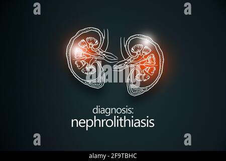 Nephrolithiasis kidney stones disease or urolithiasis. Renal Calculus ...