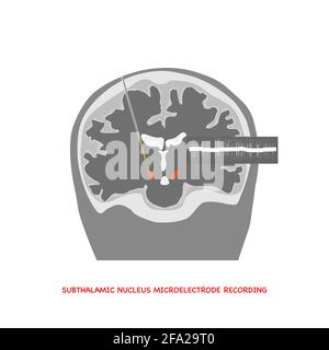 Deep brain stimulation at subthalamic nucleus for treatment of ...