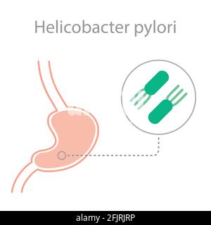 Helicobacter pylori bacteria. stomach with Peptic ulcer disease, and ...