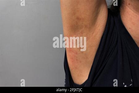 Allergic rash on the skin. Woman with dermatology problem on back skin ...