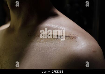 Wound on the skin. Body with collarbone injury. The operating seam is ...
