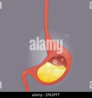 Acid reflux, heartburn and gerd infographic with stomach medical ...