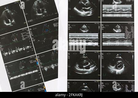 Normal heart, ultrasound scan Stock Photo - Alamy