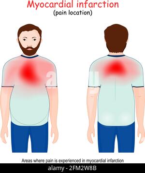 Cardiovascular Disease Heart Attack Coronary Artery Illness Symptoms ...