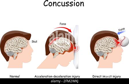 vector illustration of traumatic brain injury. titanium plate Stock ...