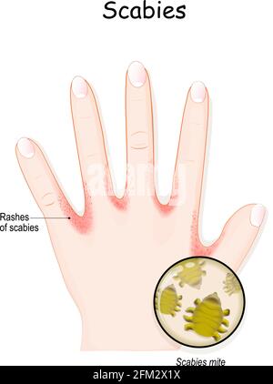 Scabies. contagious skin infestation. Close-up of scabies mite and ...