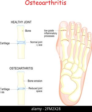 Osteoarthritis. Healthy Synovial joint and knee with Arthritis or pain ...