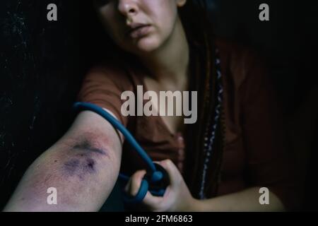 bruises on woman arm skin Stock Photo - Alamy
