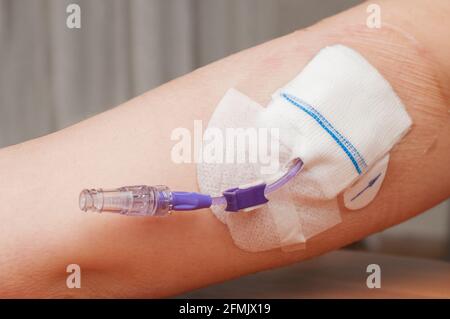 PICC line (peripherally inserted central catheter line) inserted in arm ...