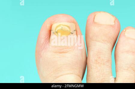 Orthonyx Bracket, toenail clamp is mounted on an ingrown toenail, close ...