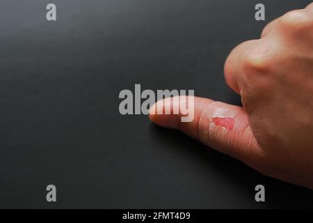 skinning skin between the fingers, the hands of one person injured ...