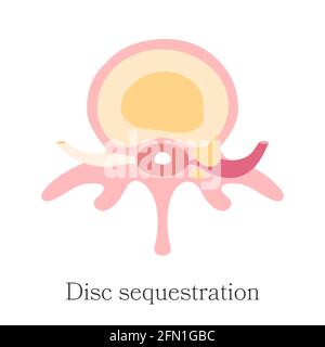 Stages of disc herniation spine and disc anatomy 3d medical vector ...