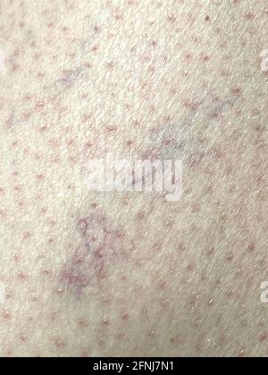 spider broken leg Stock Photo - Alamy
