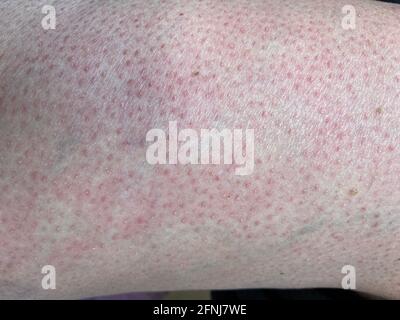 Urticaria rash, also known as nettle rash or hives, caused by a food ...