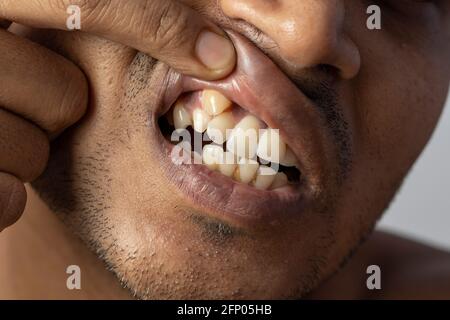 Close-up of irregular teeth shown by an Indian man Stock Photo - Alamy