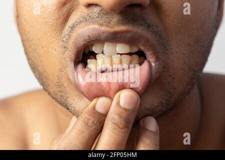 Close-up of irregular teeth shown by an Indian man Stock Photo - Alamy