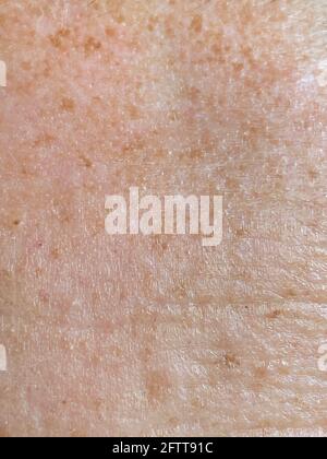 melasma lentigo on the skin of a man macro photo. Skin pigmentation ...