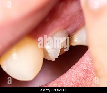 A black dead tooth in which a piece of tooth enamel is chipped off, a ...