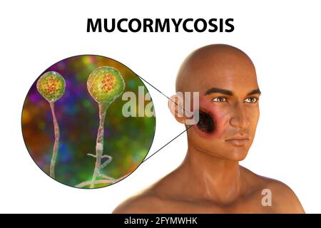 Cutaneous mucormycosis, illustration Stock Photo - Alamy