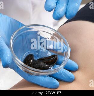 Doctor holding medical leeches. Hirudotherapy. Alternative medicine ...