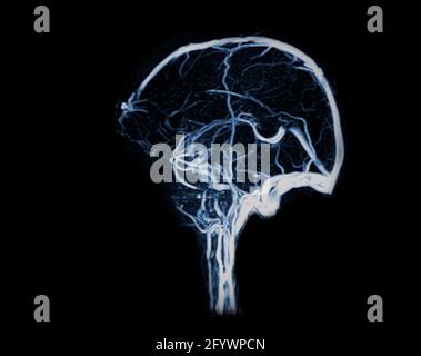 MRV Brain or magnetic resonance venography of The Brain for ...