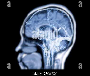 MRV Brain or magnetic resonance venography of The Brain for ...