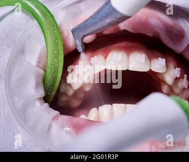 The process of cleansing the mouth of saliva. Dental procedures. High ...