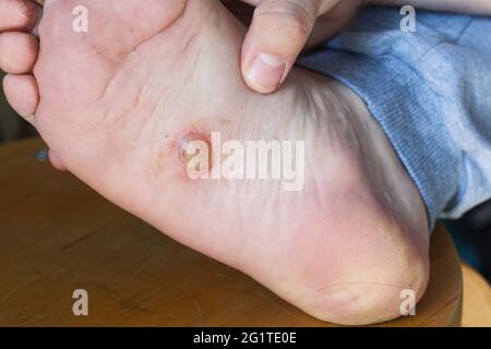 Dyshidrotic eczema on the foot. Blister dermatitis. A gloved hand holds ...