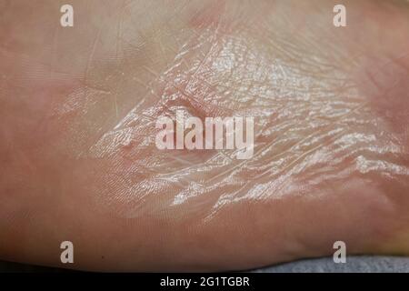 Dyshidrotic eczema on the foot. Blister dermatitis. A gloved hand holds ...