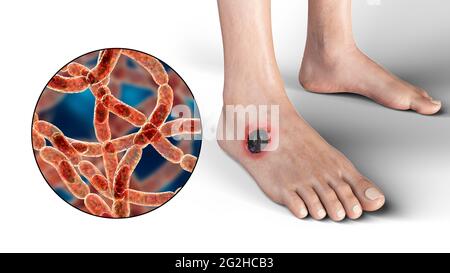 Cutaneous anthrax, illustration Stock Photo - Alamy