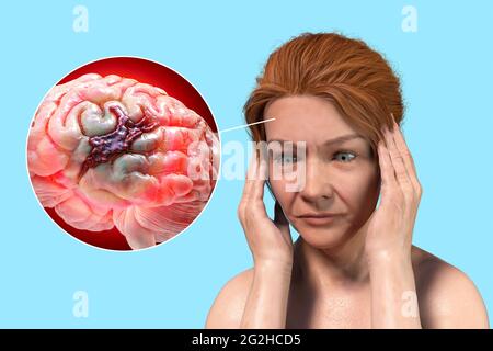 Haemorrhagic stroke. Illustration of a ruptured blood vessel in the ...