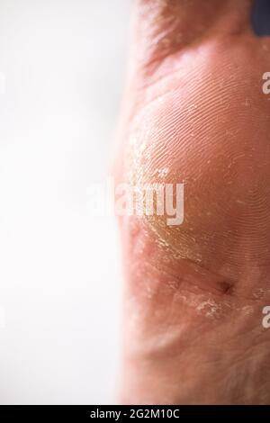 Close-up of a man leg with dermatitis scratching the blisters. Redness ...