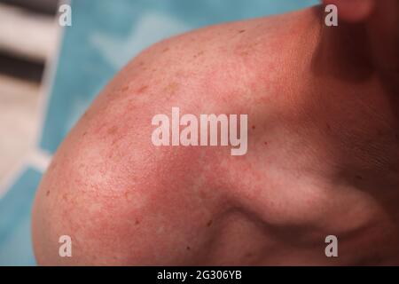 Male shoulder with severe sunburn and urticaria Stock Photo - Alamy
