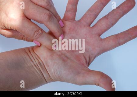 Atopic Dermatitis, Red hands, Dermatological problem, Female hands ...