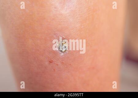 Pimple Folliculitis on buttock caused by infection from bacteria, yeast ...