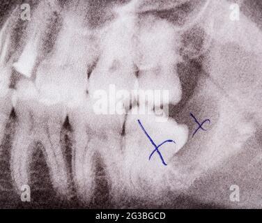 DENTAL ABSCESS, X-RAY Stock Photo - Alamy