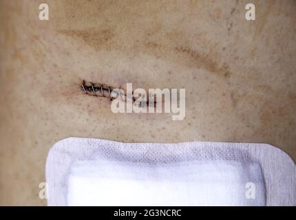 Appendix removal surgical suture Stock Photo - Alamy
